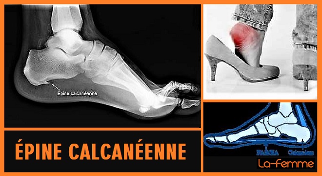 L'épine calcanéenne (excroissance douloureuse du talon), diagnostic et ...